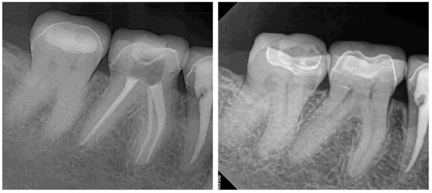 Root Canal Treatments in Bellevue, WA | Cascadia Dental Specialists